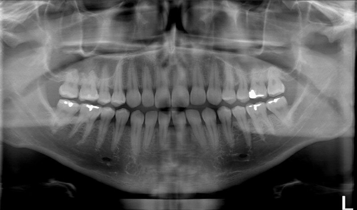 Will tomosynthesis enable panoramic bitewings? | DrBicuspid.com