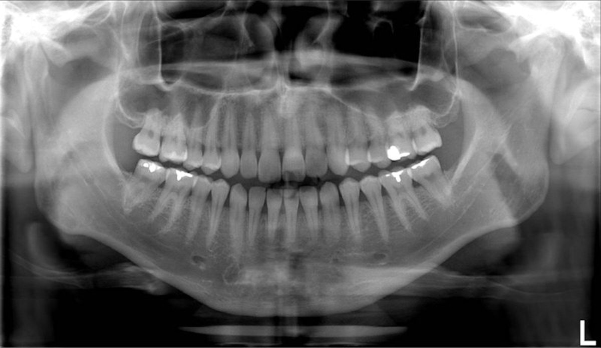 Will tomosynthesis enable panoramic bitewings? | DrBicuspid.com