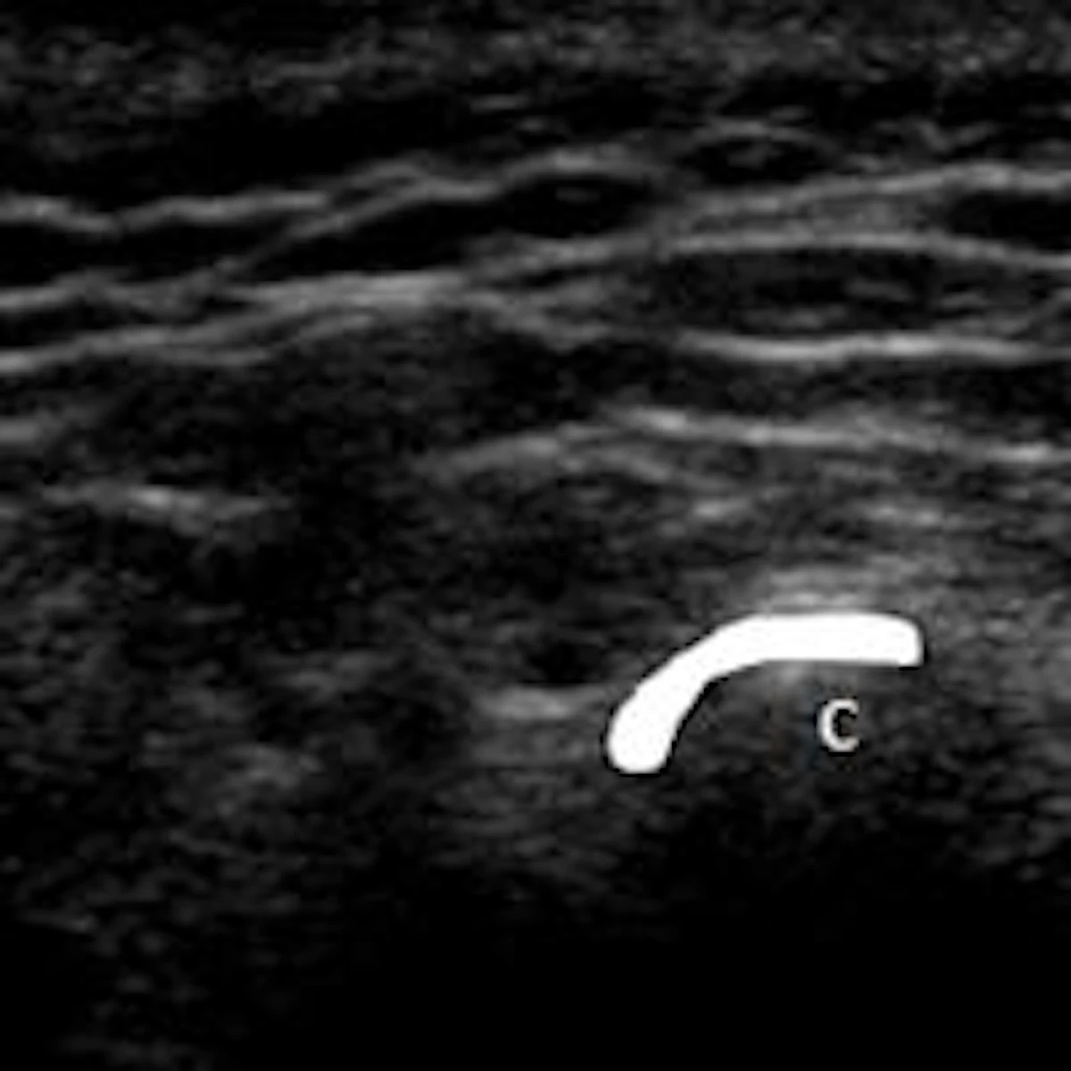 Ultrasound useful for screening for TMJ dysfunction | DrBicuspid.com