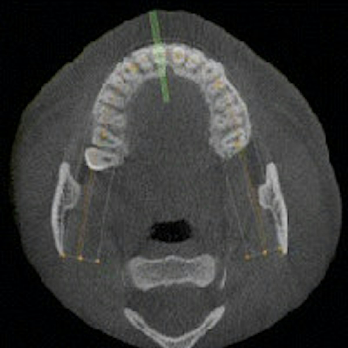 Treatment planning with CBCT key to maxillary implant success ...