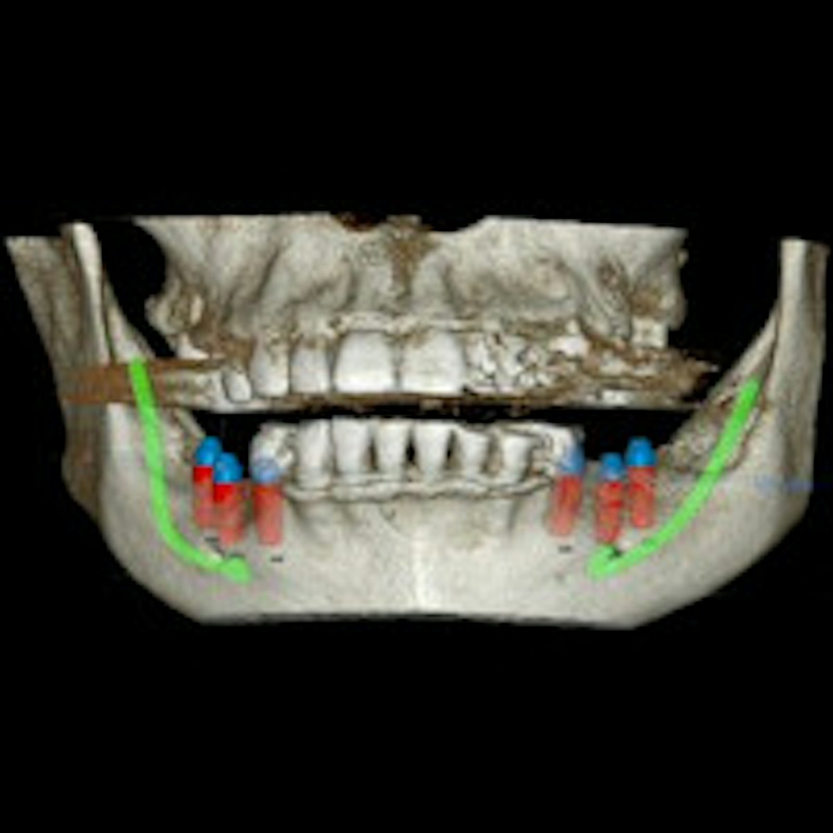 Create a master cast for implants using digital tech | DrBicuspid.com