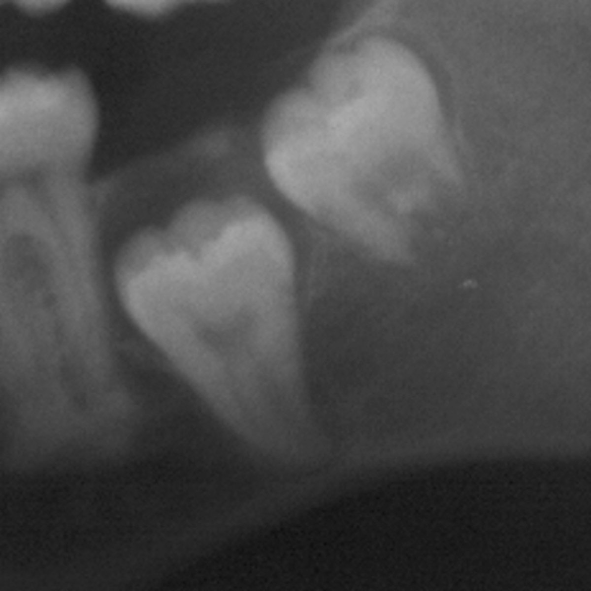 Imaging offers perspective on third-molar extractions | DrBicuspid.com