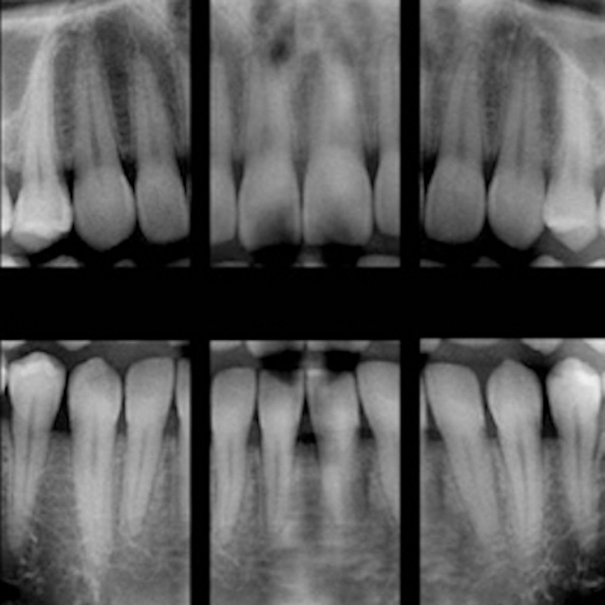 Study tests bitewings for detecting caries in primary teeth ...