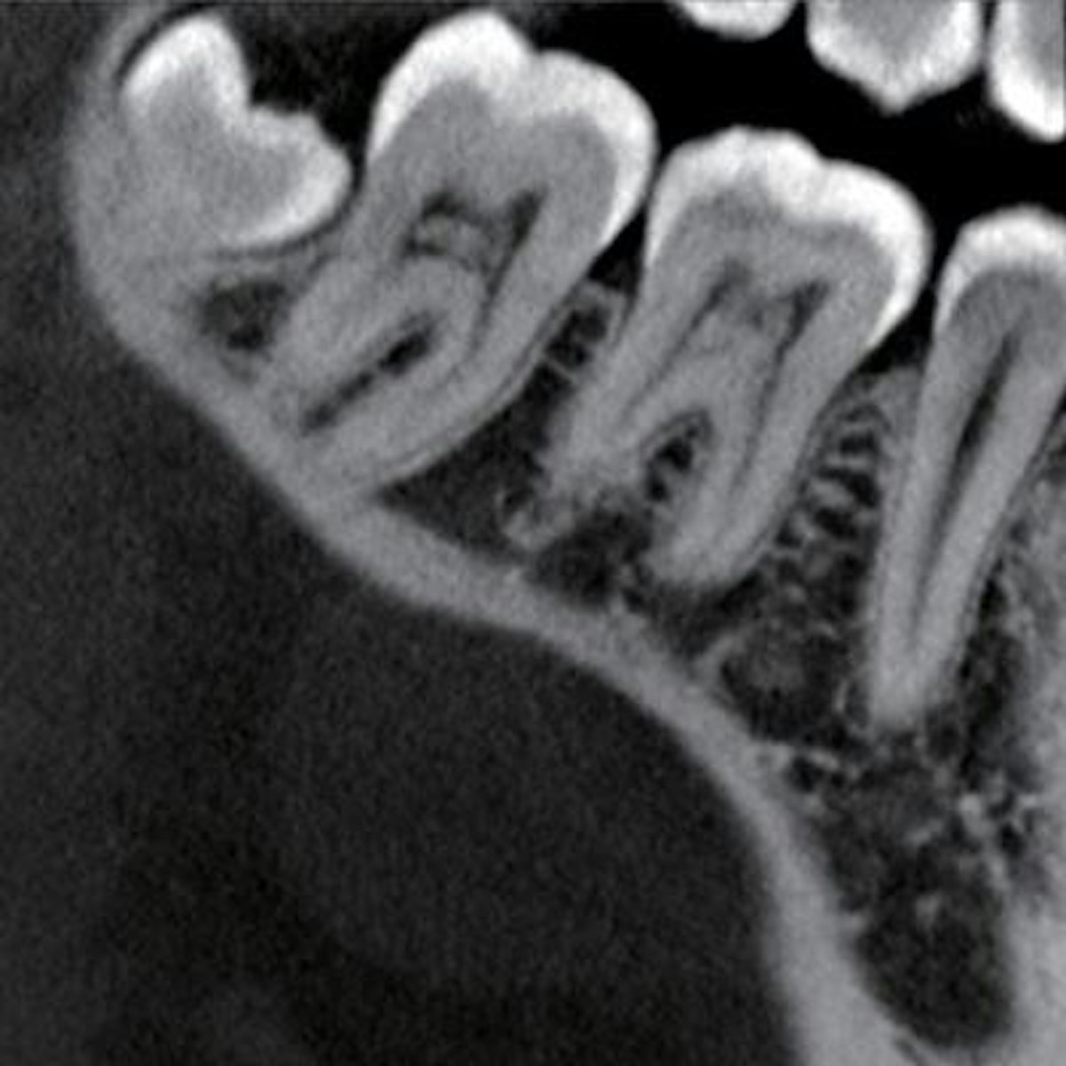 Study compares CBCT, digital radiography for pulp stone imaging ...