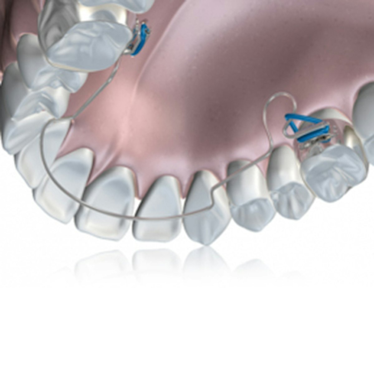 Treating kids with an advanced lightwire functional device | DrBicuspid.com