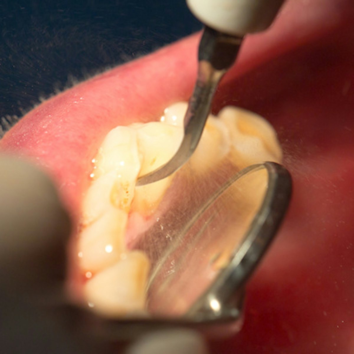 Study confirms long-term perio treatment works | DrBicuspid.com