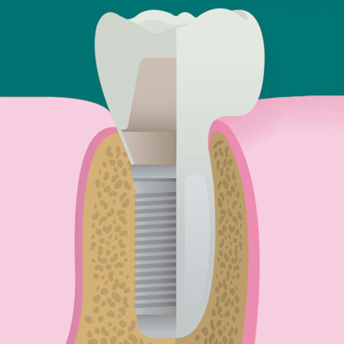Study: Ultrasound tops CBCT in peri-implant bone imaging | DrBicuspid.com