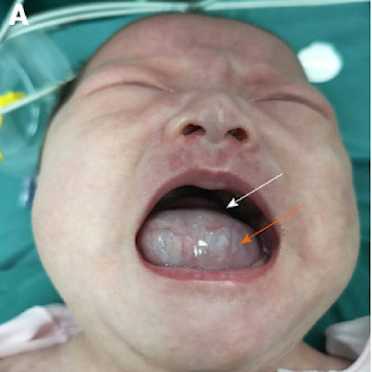 Photos: Rare mouth-filling cysts cause extreme issues for infant ...