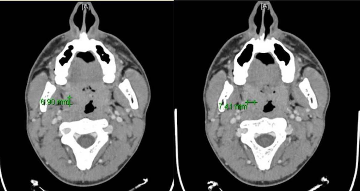 tonsillar abscess radiopaedia