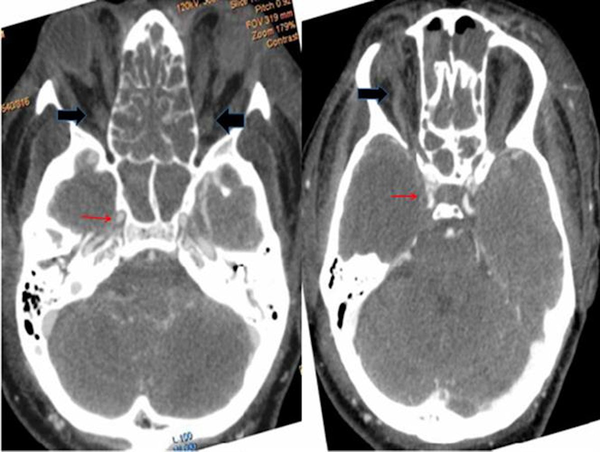 cavernous sinus thrombosis
