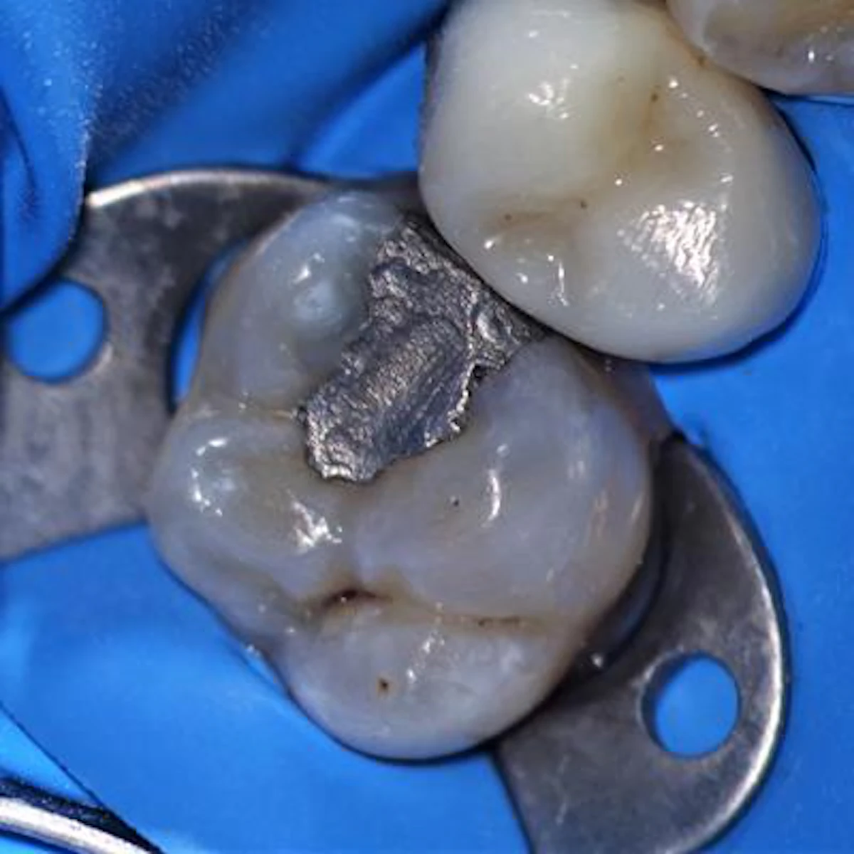 Case report: Universal composite repairs leaking amalgam | DrBicuspid.com