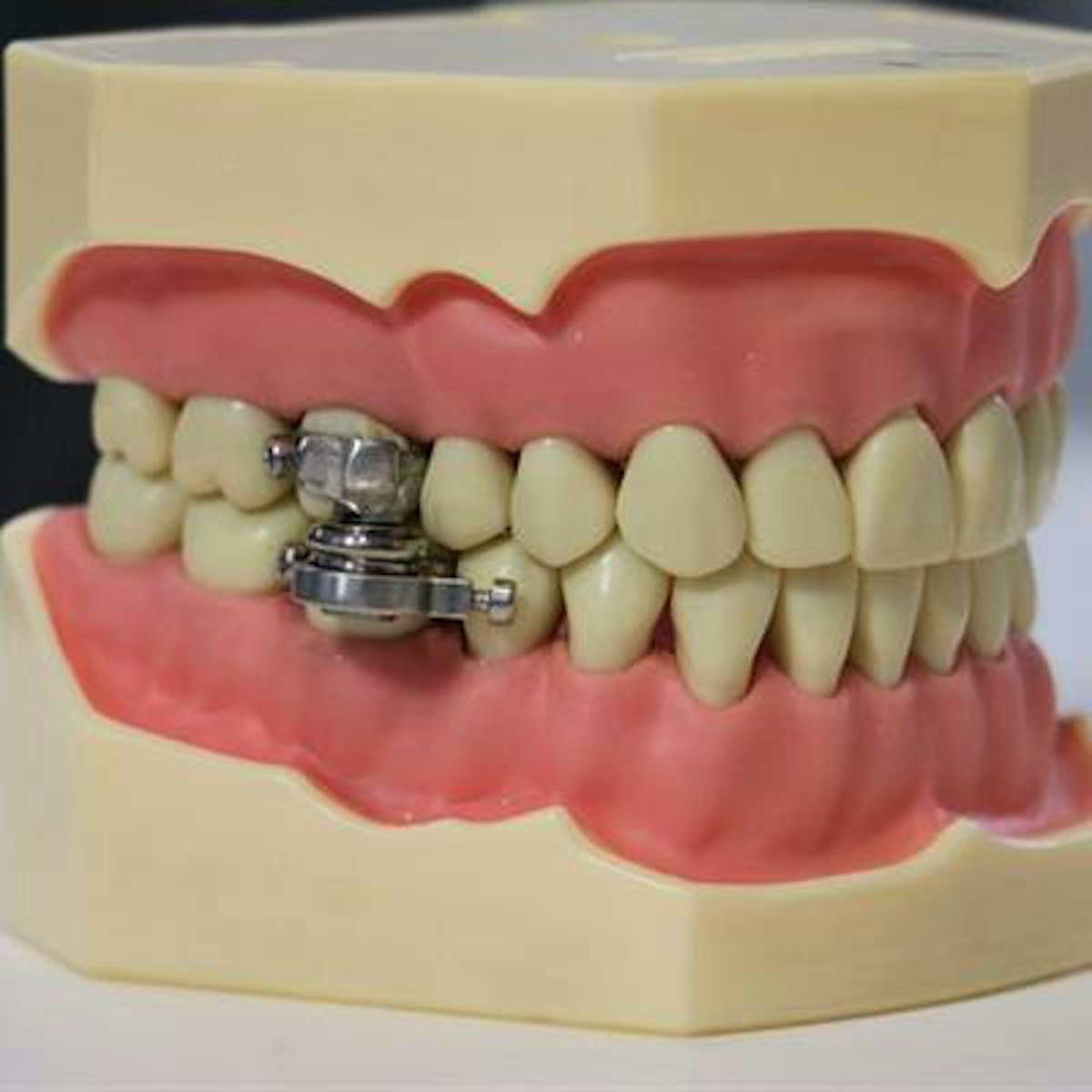 Mouth lock spurs weight loss by cutting calories | DrBicuspid.com