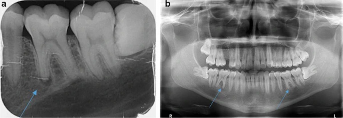 periodontitis x rays