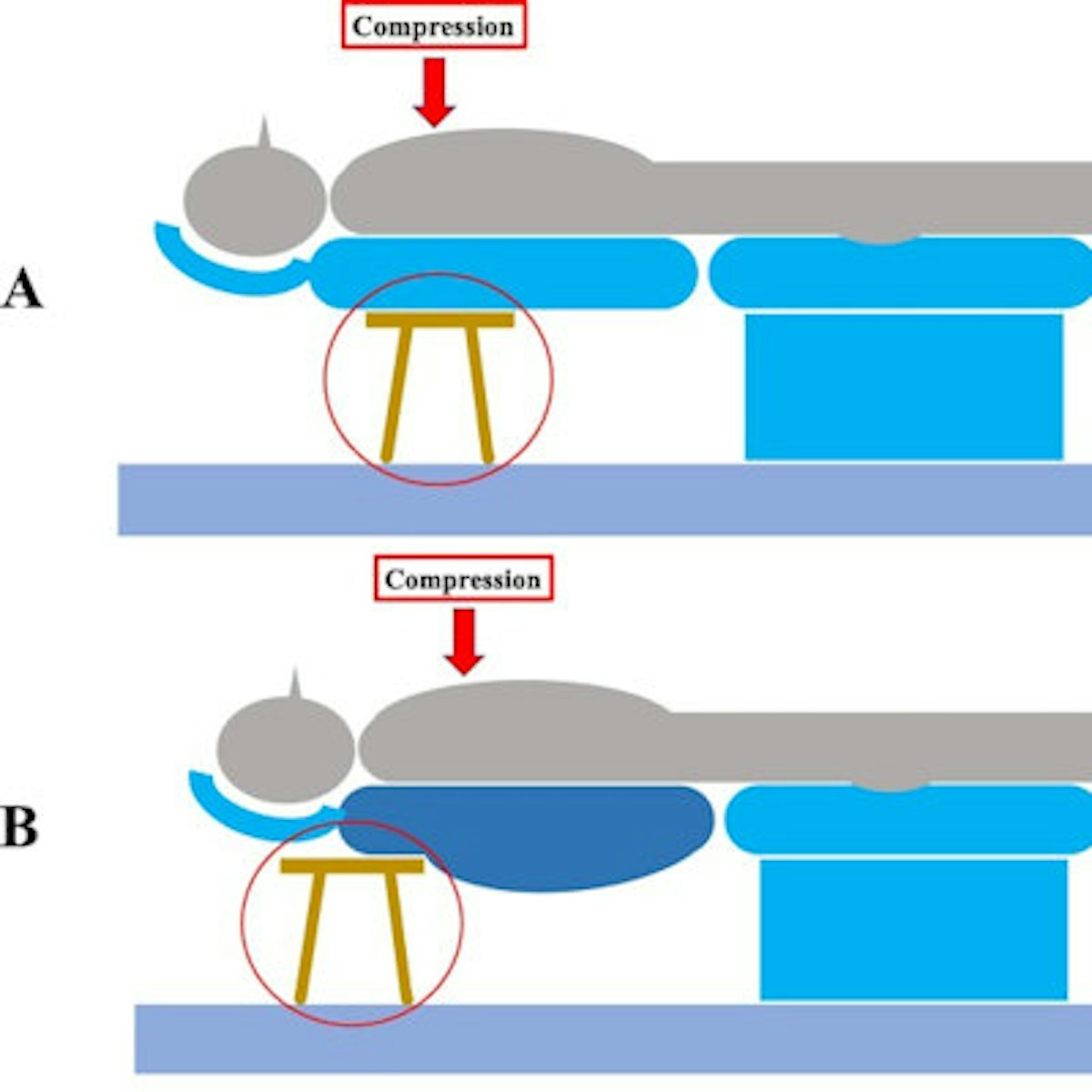 Support stool can be a hack for optimal CPR in dental chairs ...