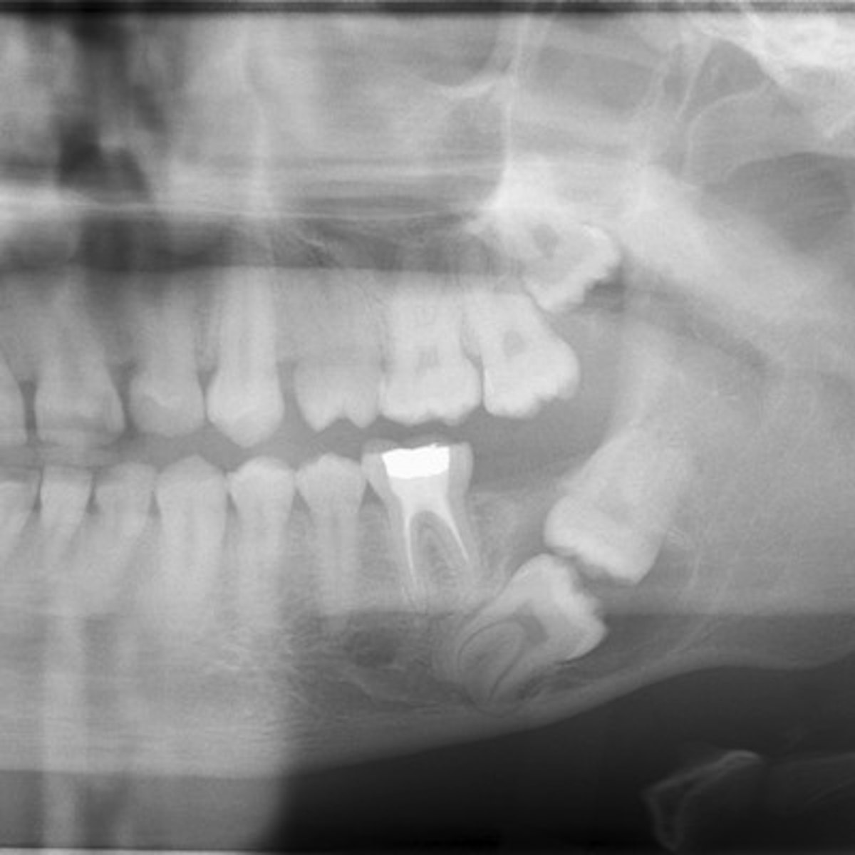 Imaging aids in treating 20-year-old's bilateral kissing molars ...