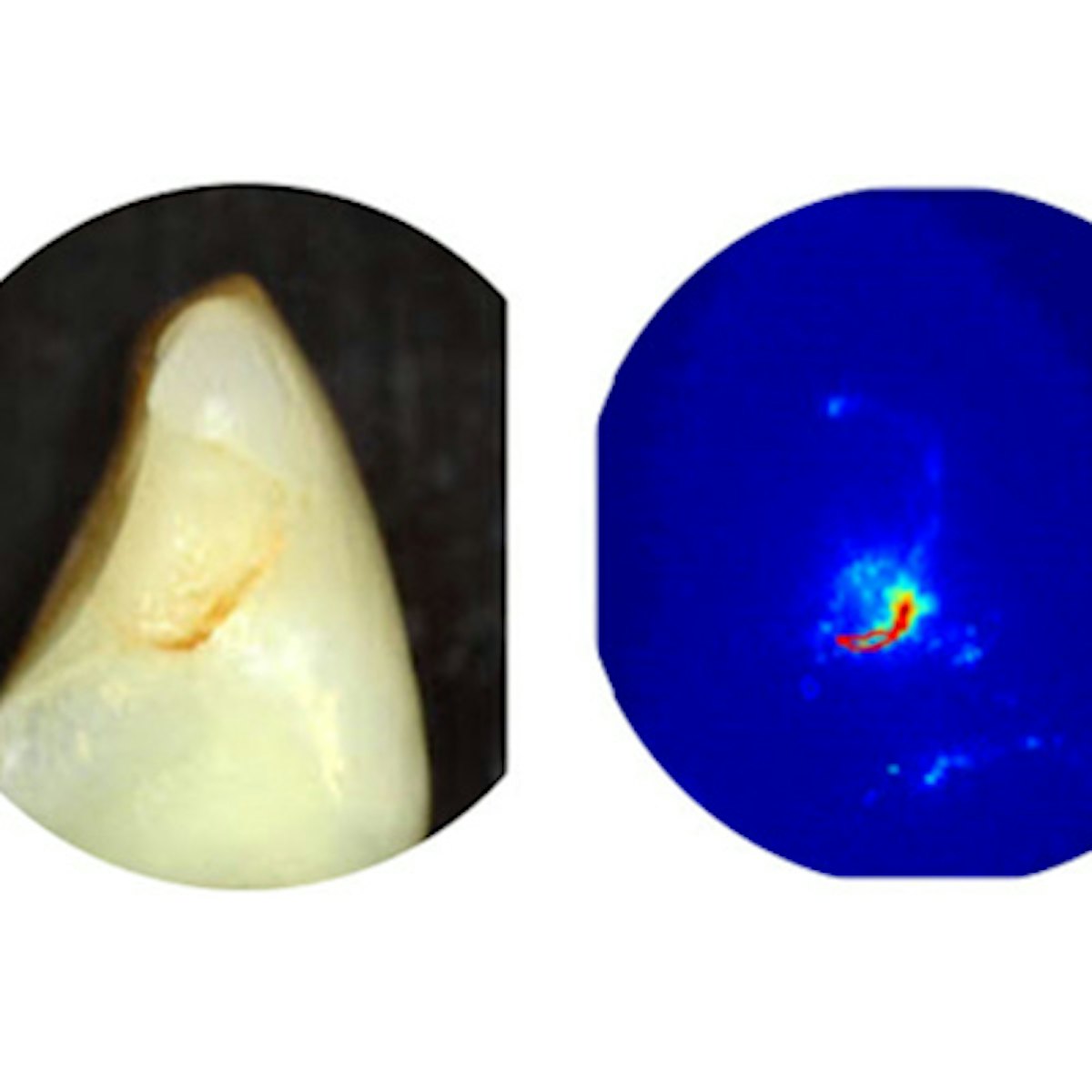 Imaging methods monitor dental caries activity after restoration ...
