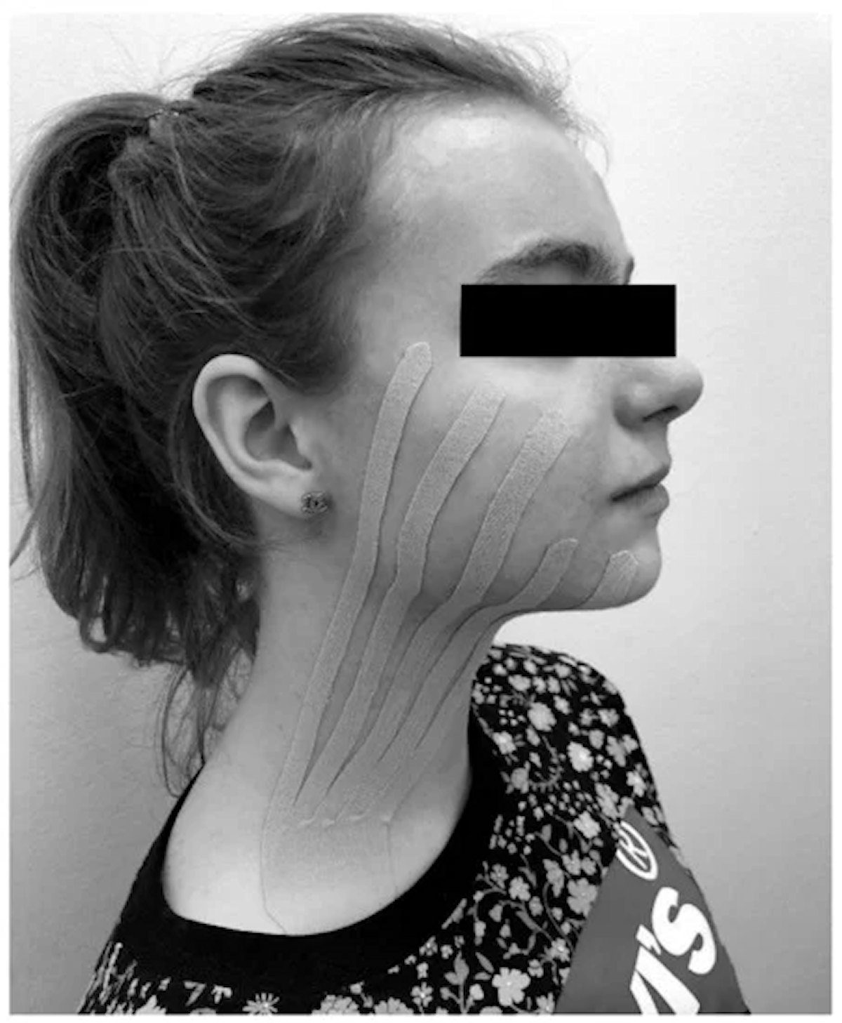 A sticky way to combat 3rd-molar surgery complications | DrBicuspid.com