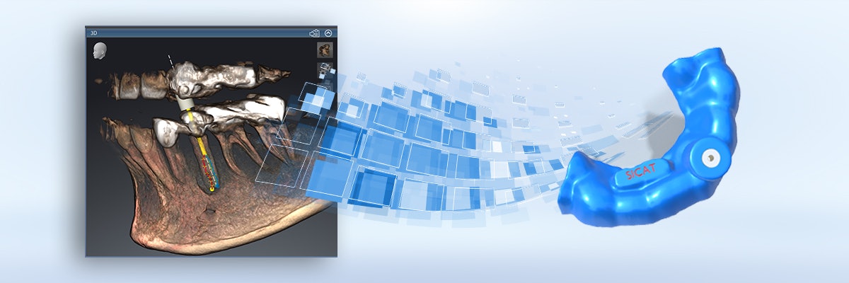 SICAT launches 1st AI based endodontics surgical guide | DrBicuspid.com