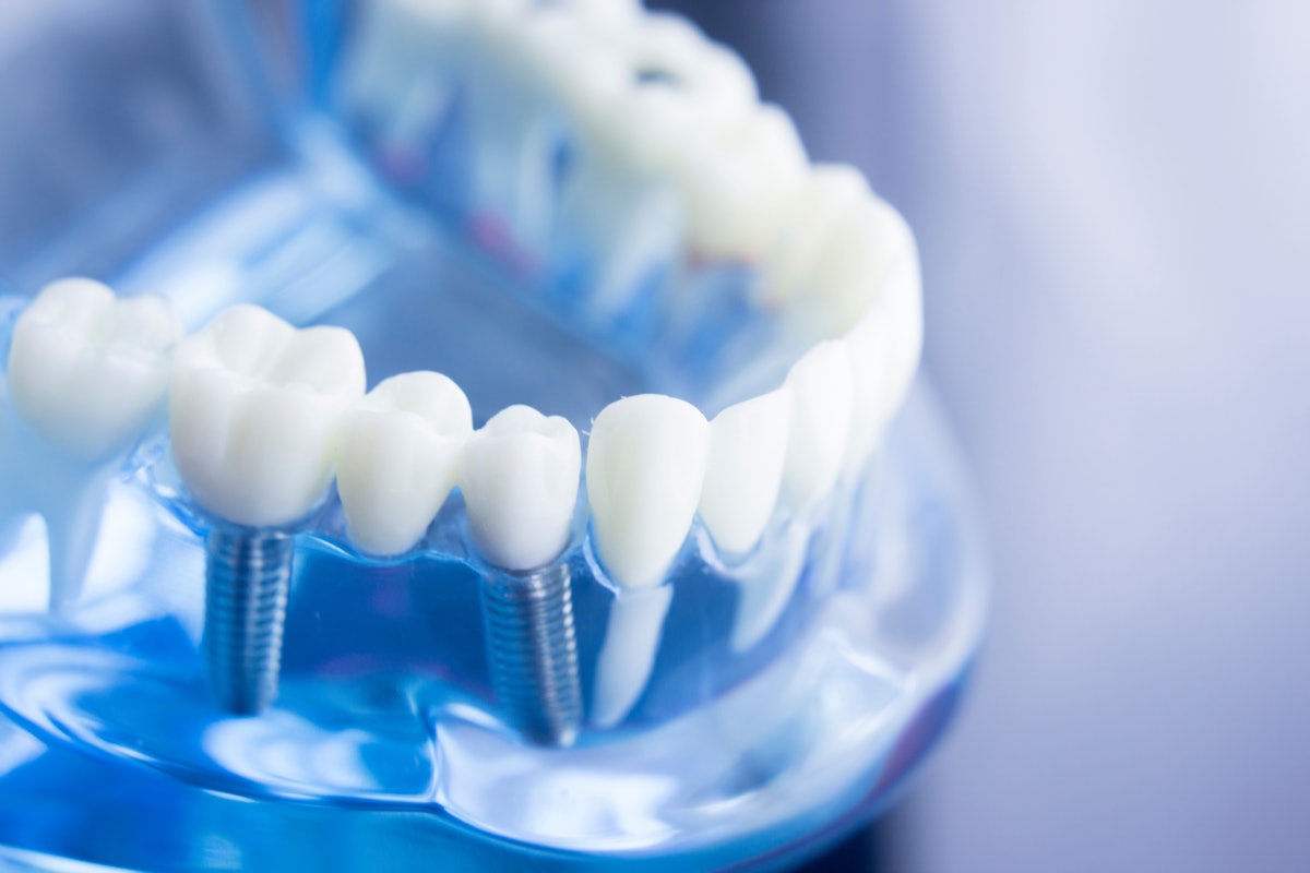 Keystone Dental launches new implant system | DrBicuspid.com