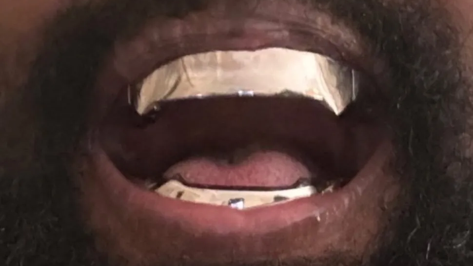 Artist Ye makes outrageous dental transformation | DrBicuspid.com