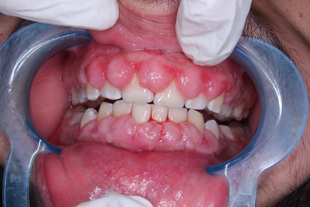 gingival hyperplasia