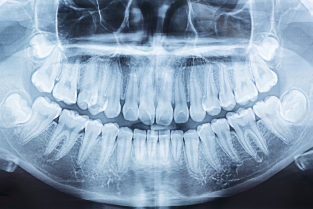 bone resorption x ray