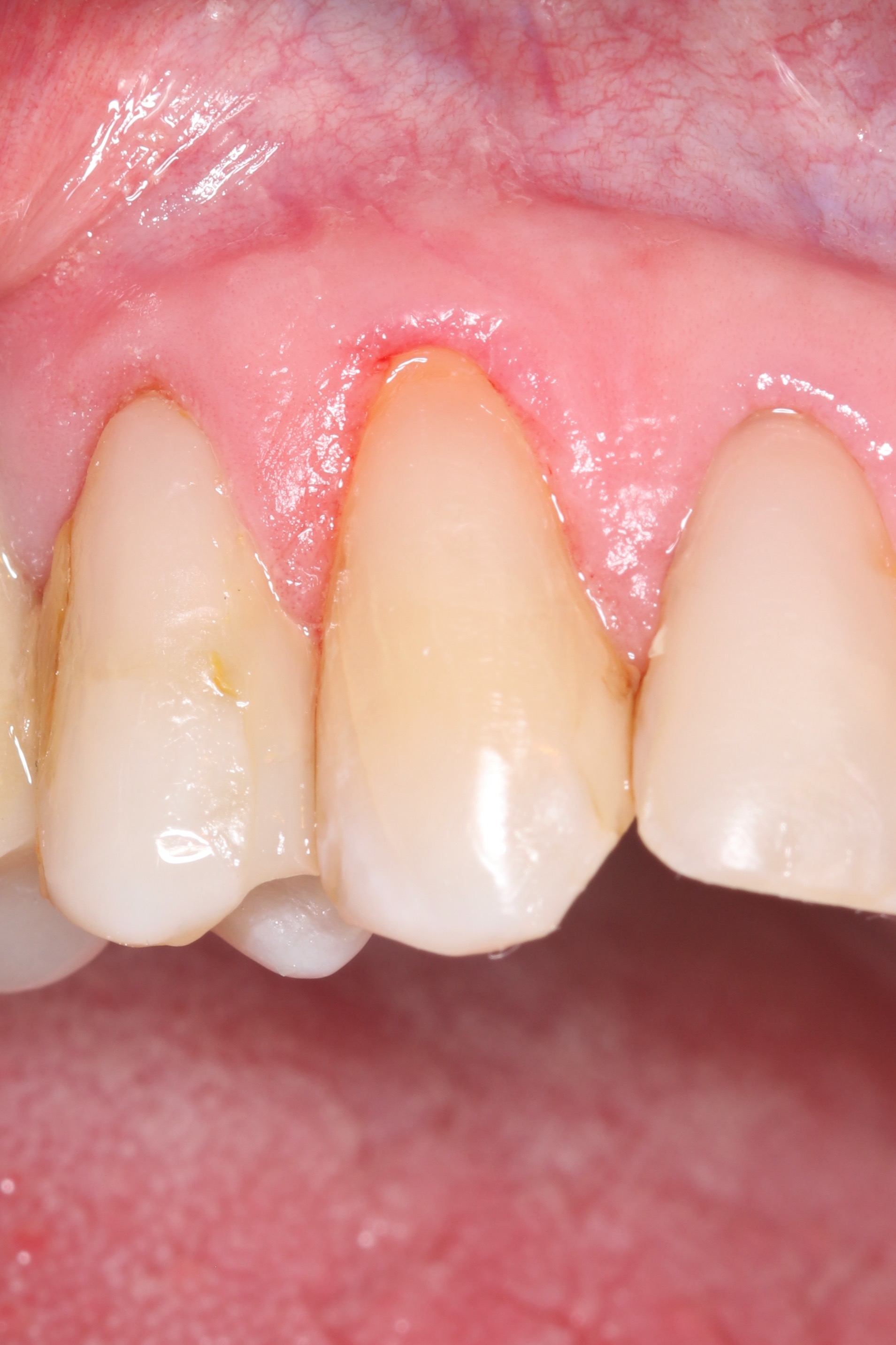 Conservative management of class V lesions | DrBicuspid.com