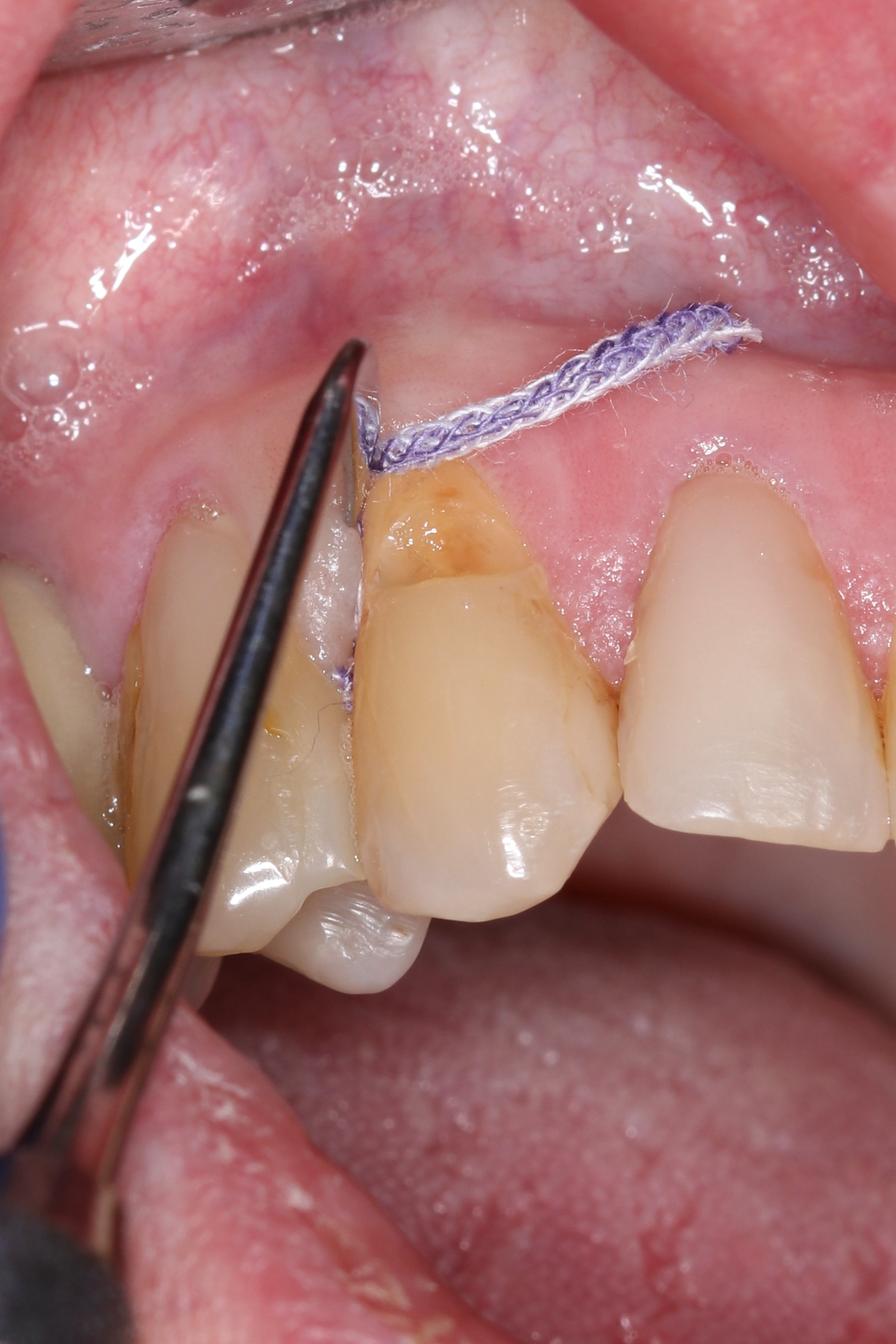 Conservative management of class V lesions | DrBicuspid.com