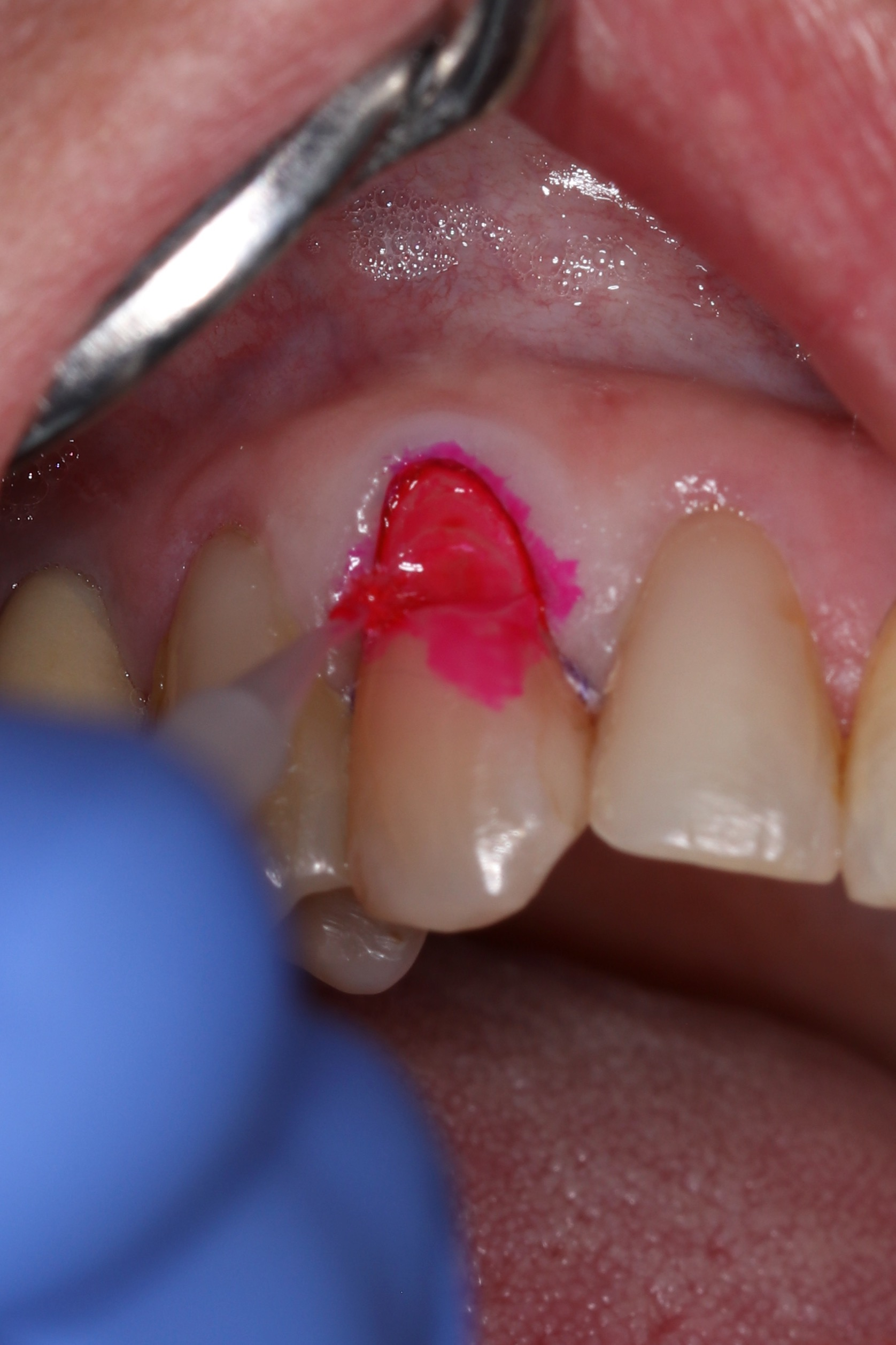 Conservative management of class V lesions | DrBicuspid.com