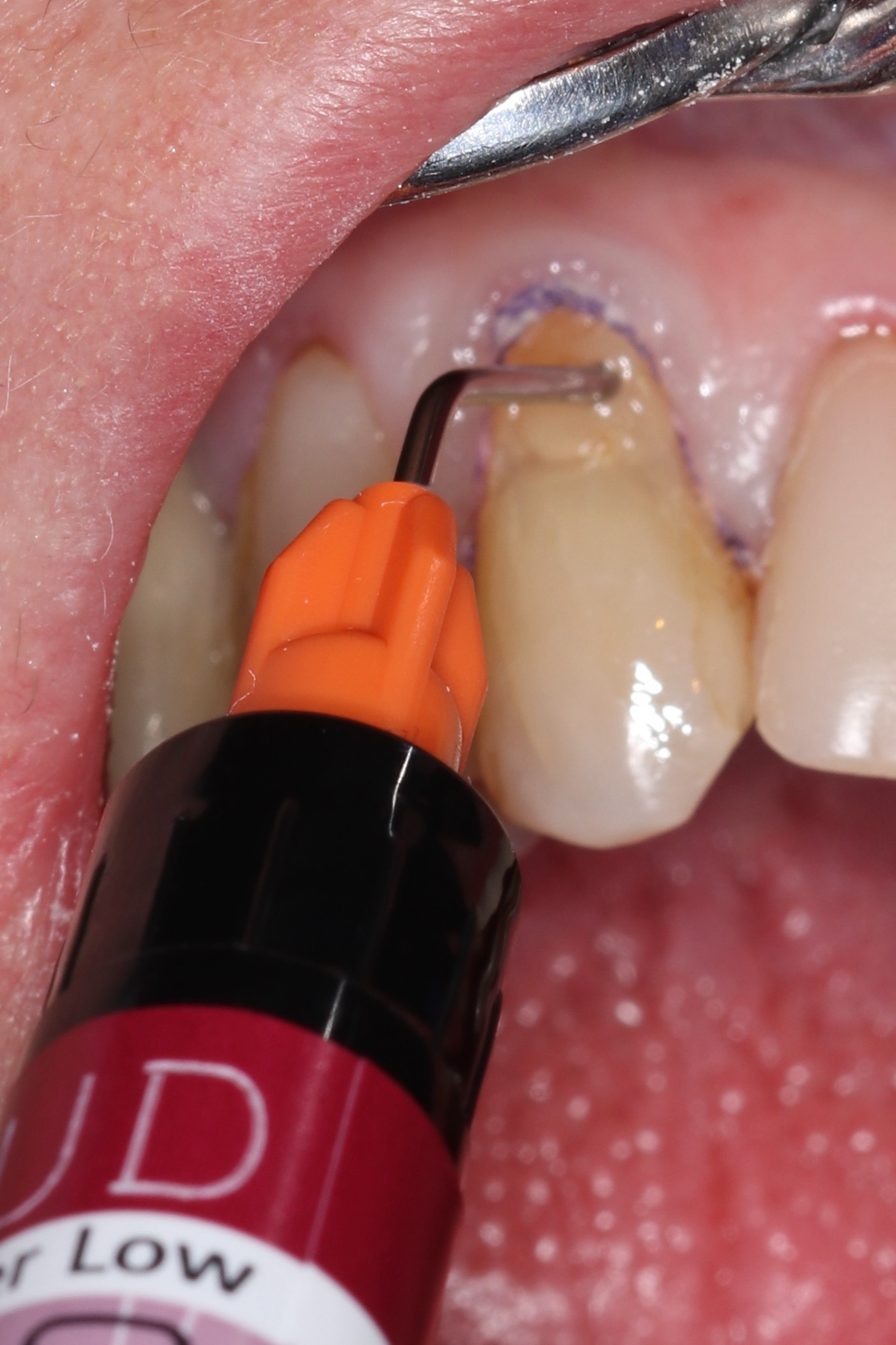 Conservative management of class V lesions | DrBicuspid.com