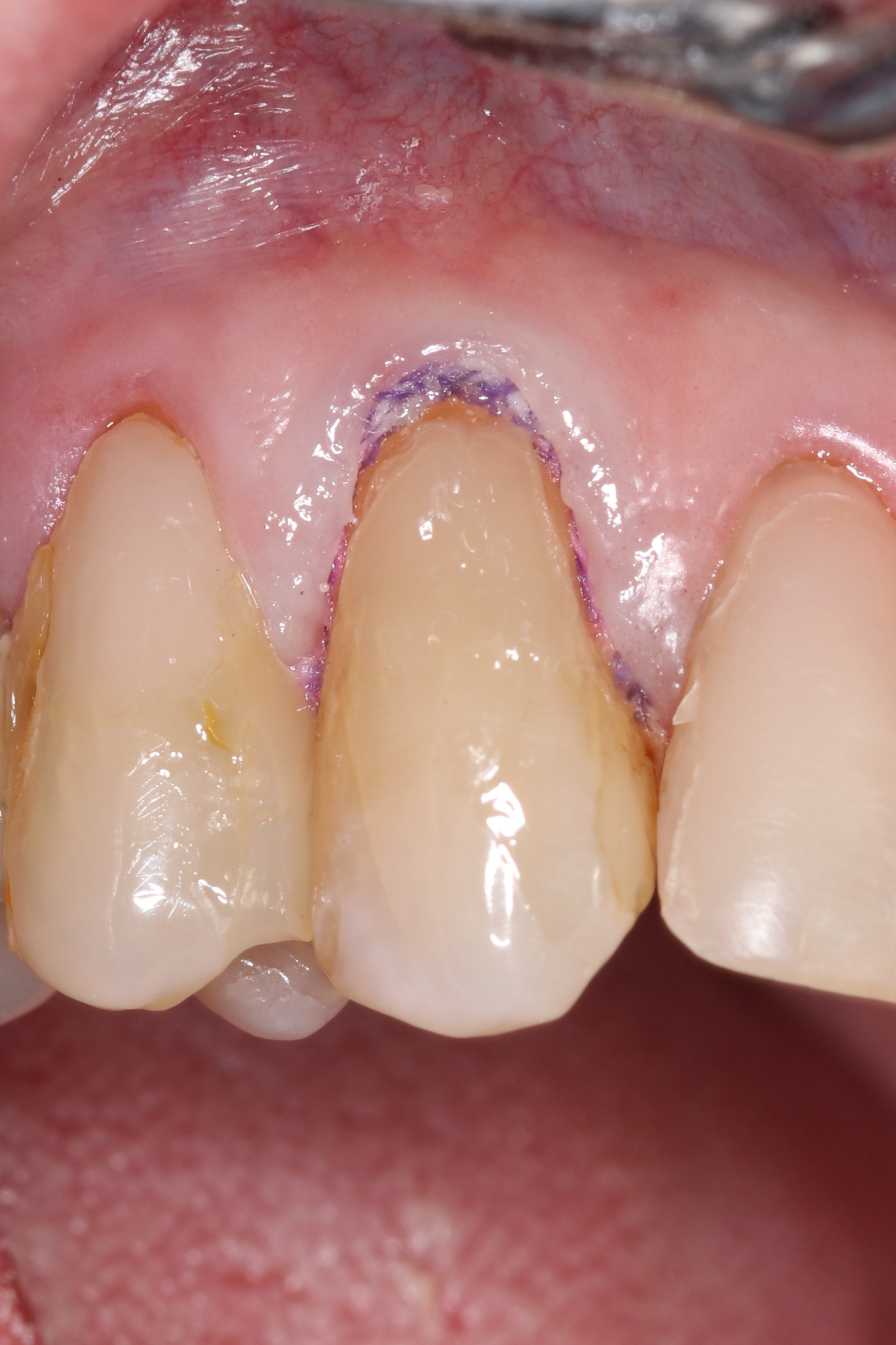 Conservative management of class V lesions | DrBicuspid.com