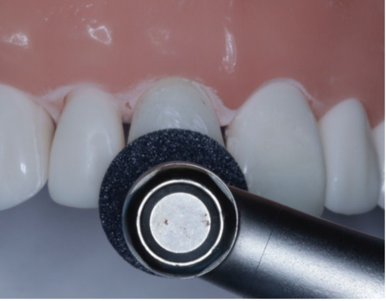 Shofu Super-Snap Polishing System review | DrBicuspid.com