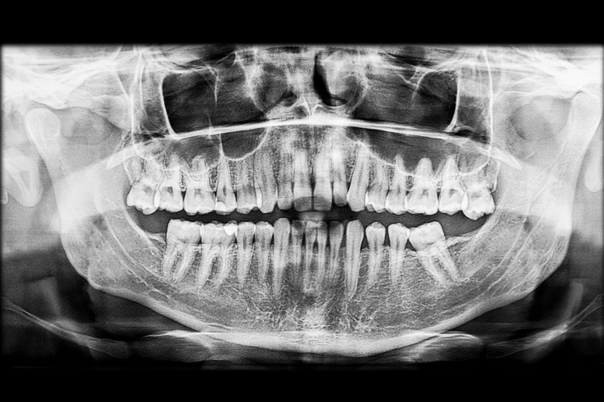 This tool may read dental x-rays better | DrBicuspid.com