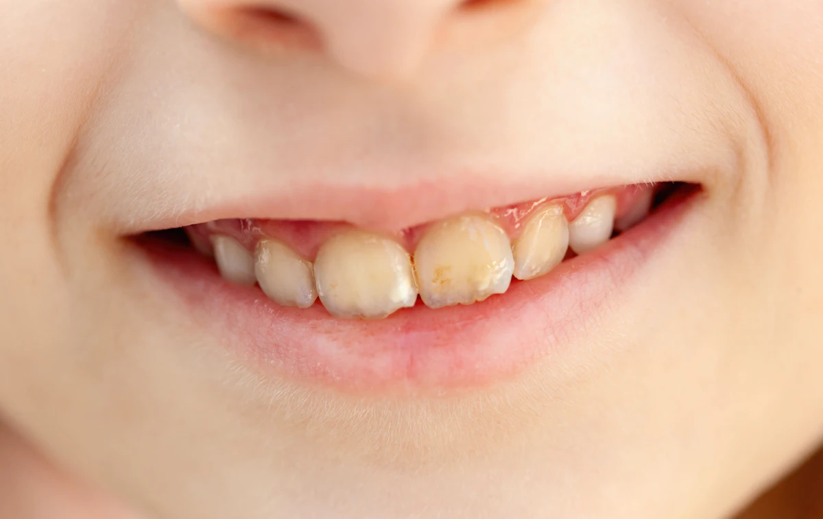 Early salivary biomarkers may reflect enamel defects | DrBicuspid.com