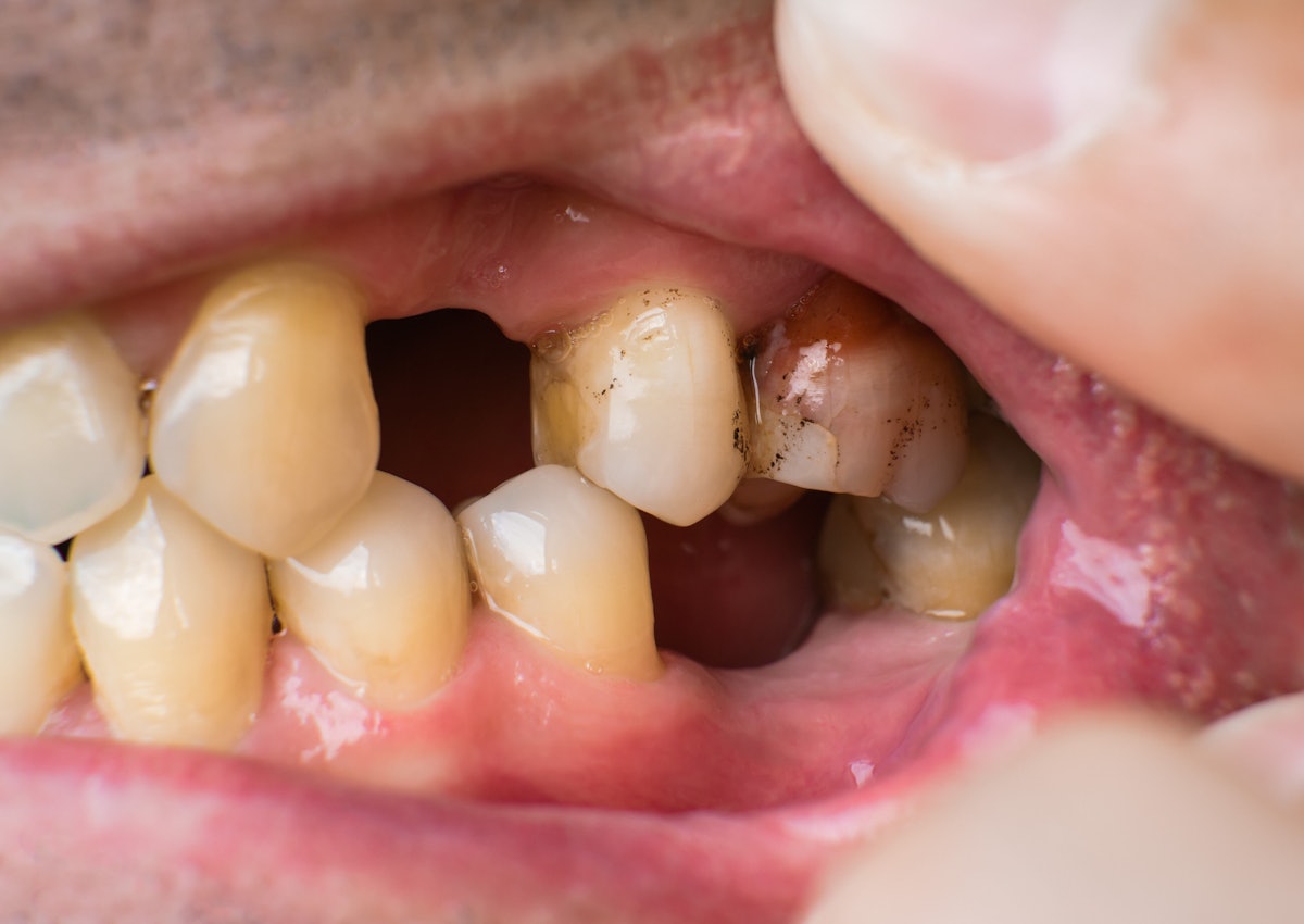 Socioeconomic disparities in caries among U.S. adults persist ...